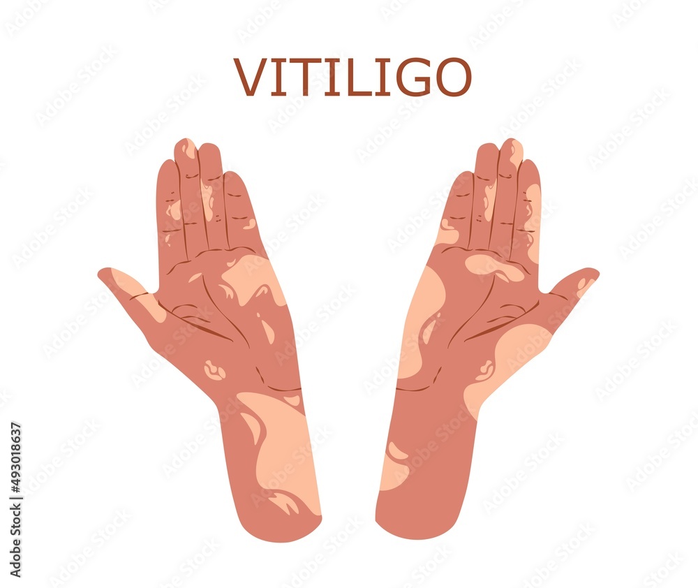 Hands with vitiligo disorder. Poster for supporting people living with ...