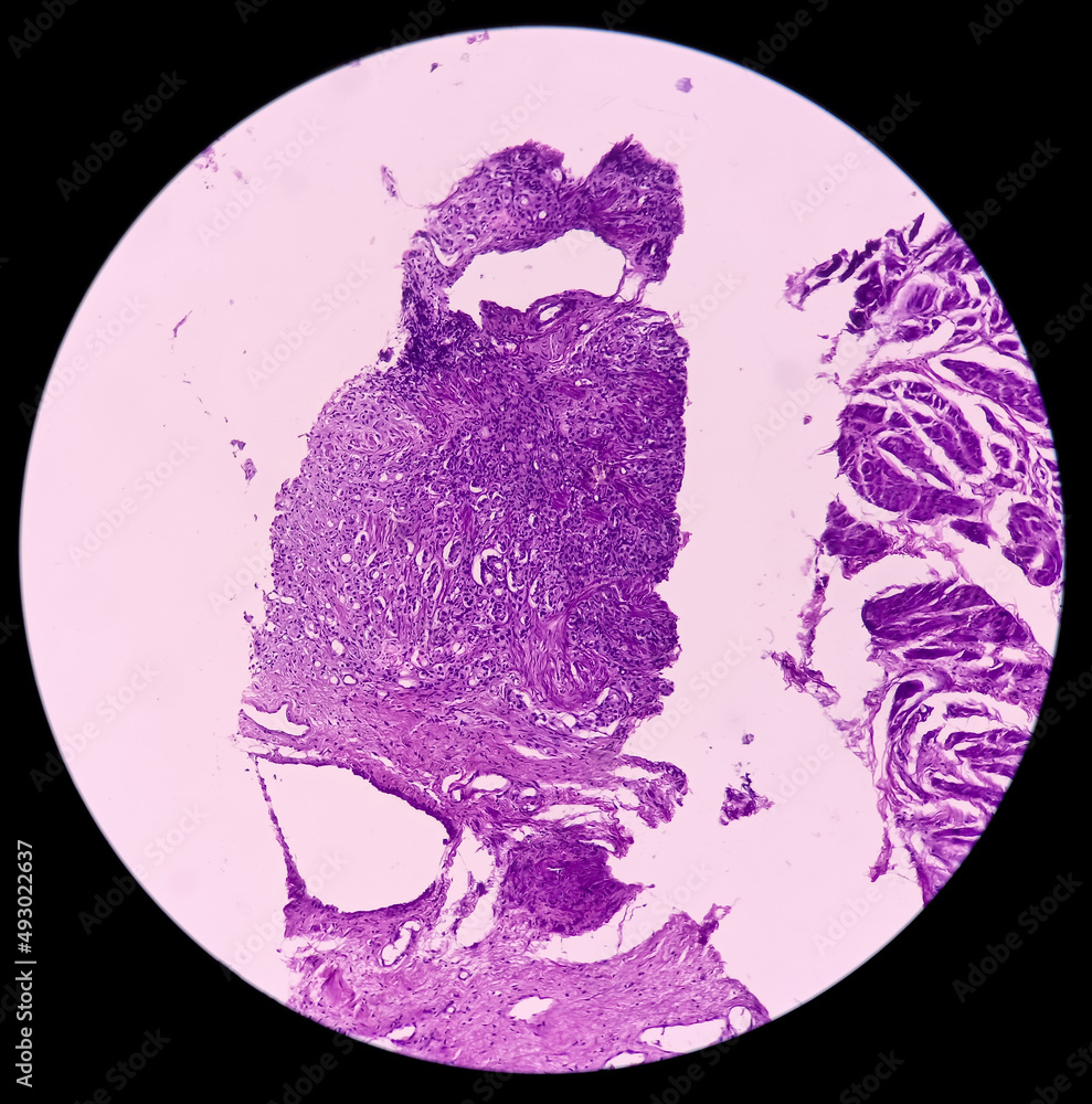 Prostate Cancer: Photomicrograph of biopsy of prostate gland showing ...