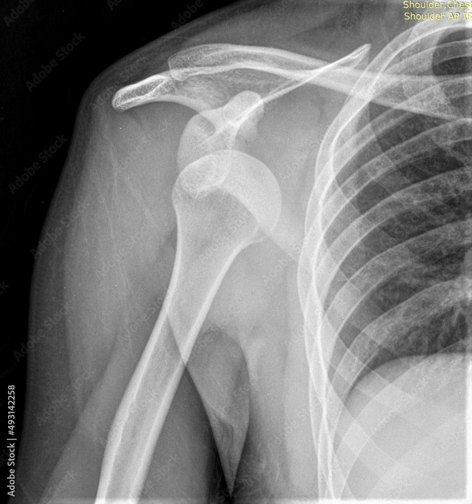 right shoulder dislocation,Xray Stock Photo | Adobe Stock
