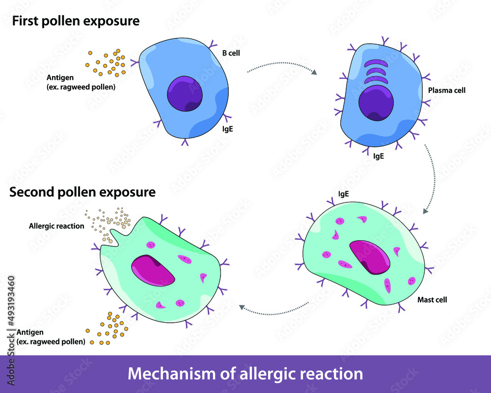 Mechanism of allergy. Immune response towards harmless antigens Stock ...