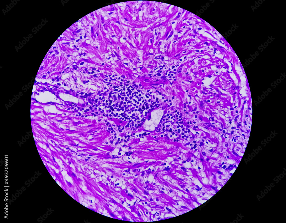 Prostate Cancer (TURP): Microscopic image of prostatic tissue ...