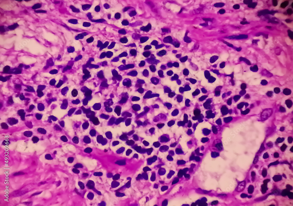 Prostate Cancer (TURP): Microscopic image of prostatic tissue ...