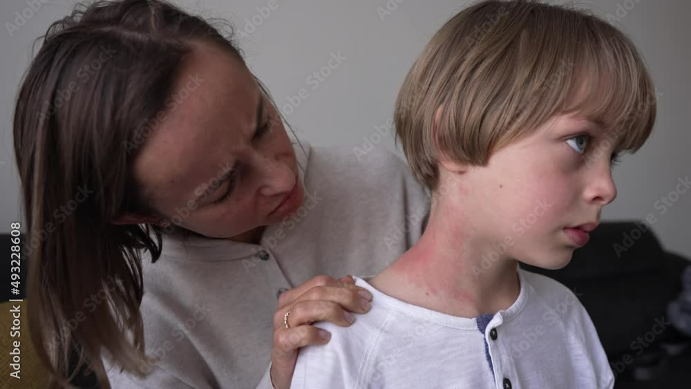 Symptoms of photodermatitis. Mom noticed a rash on the boy's neck ...