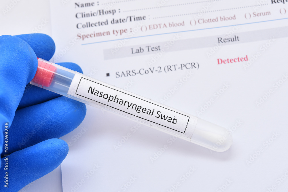COVID-19 detected, laboratory report of COVID-19 testing by using RT ...