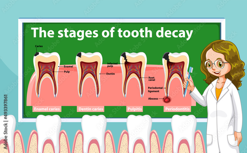 Infographic of human in the stages of tooth decay vector de Stock ...