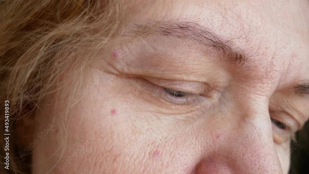 Allergic rash dermatitis on woman face skin, red allergy spots and skin ...