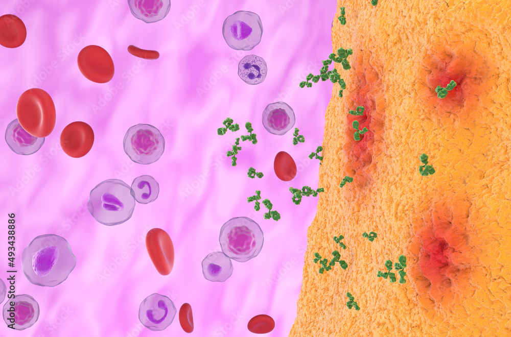 Monoclonal antibodies approach the inflammation joint in rheumatoid ...