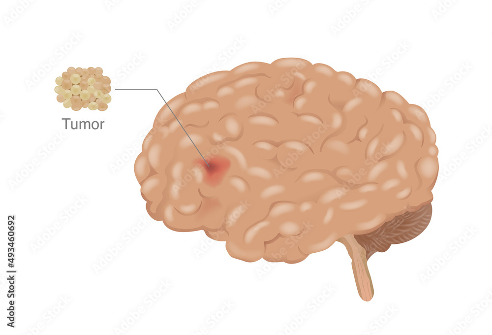 Cancer spreads to the human brain that develops be a tumor. medical ...