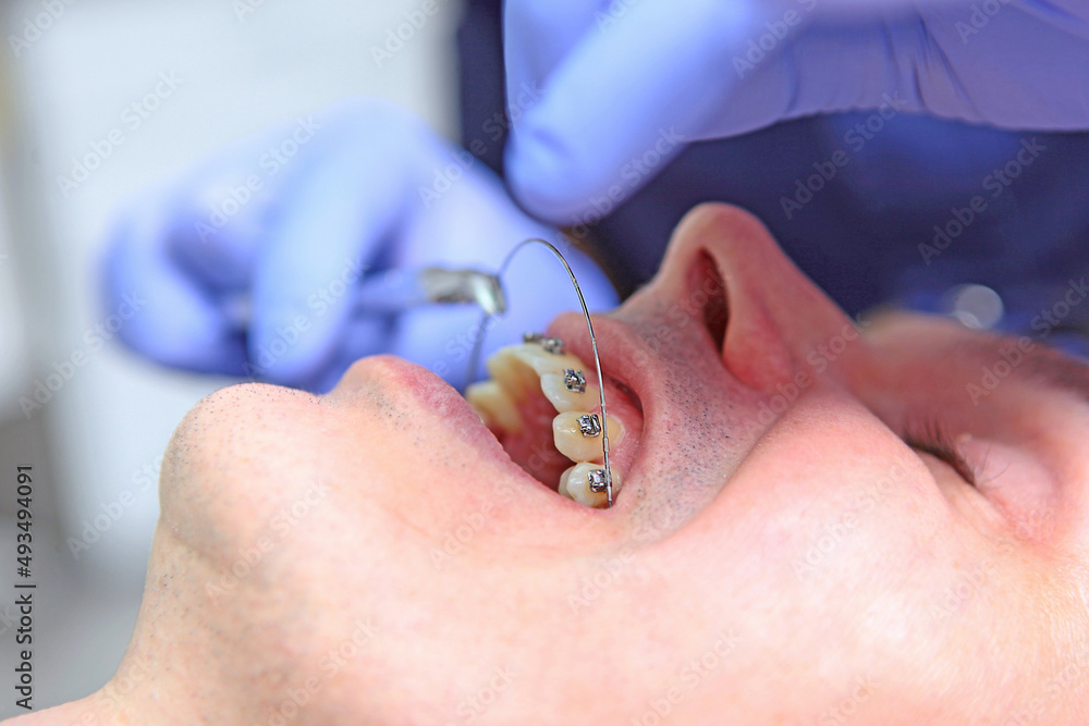 Metal arch for braces. Correction of bite and tooth growth. The work of ...