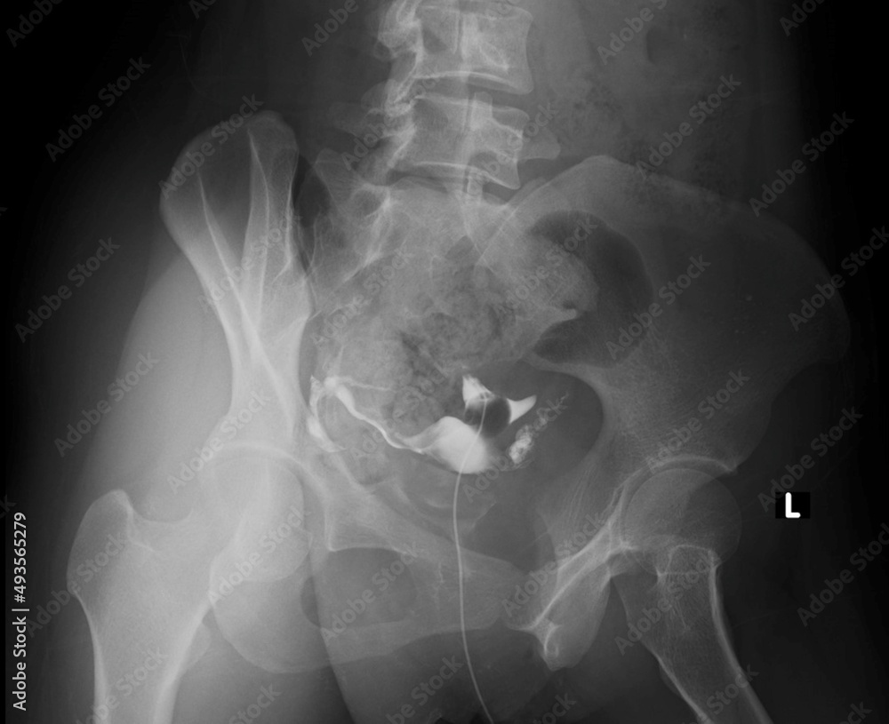x-ray image of Normal Hysterosalpingography (HSG) Stock Photo | Adobe Stock