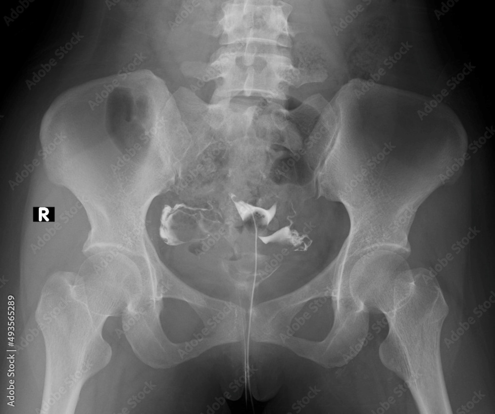 x-ray image of Normal Hysterosalpingography (HSG) Stock 写真 | Adobe Stock