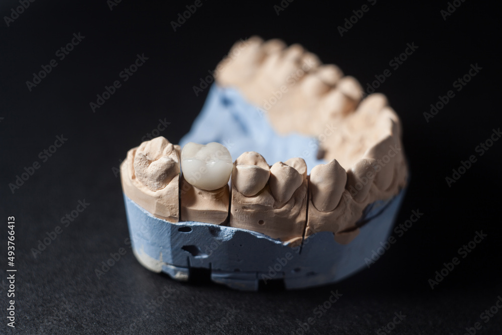 Mold of teeth. Gypsum model plaster of teeth. Stomatologic plaster cast ...