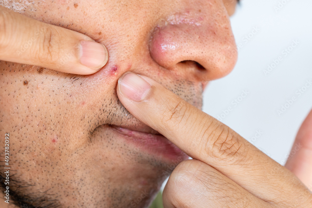 Close up of young man squeezing pimple or acne on his skin. A pimple is ...