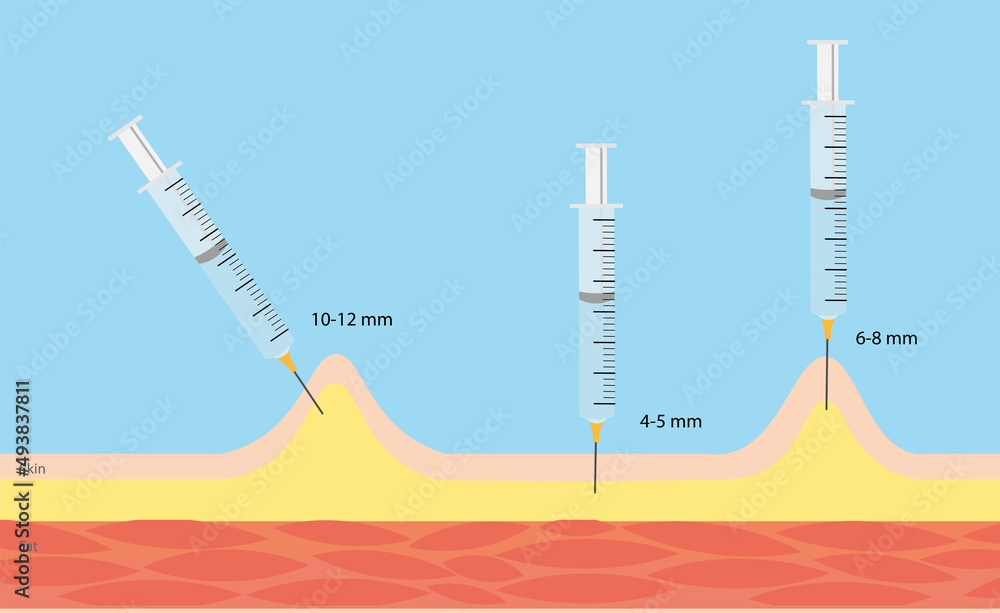 Insulin injection technique. Syringe size and angle injection technique. Stock-illustrasjon ...