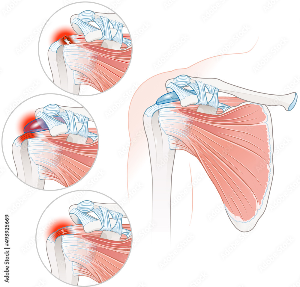 Shoulder Rotator Cuff Disease Illustration. Labeled Stock Illustration ...