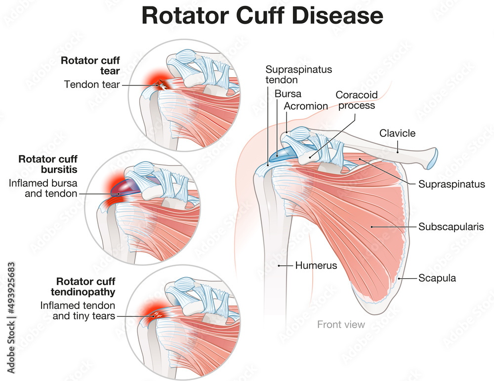 Shoulder Rotator Cuff Disease Illustration. Labeled Stock Illustration ...