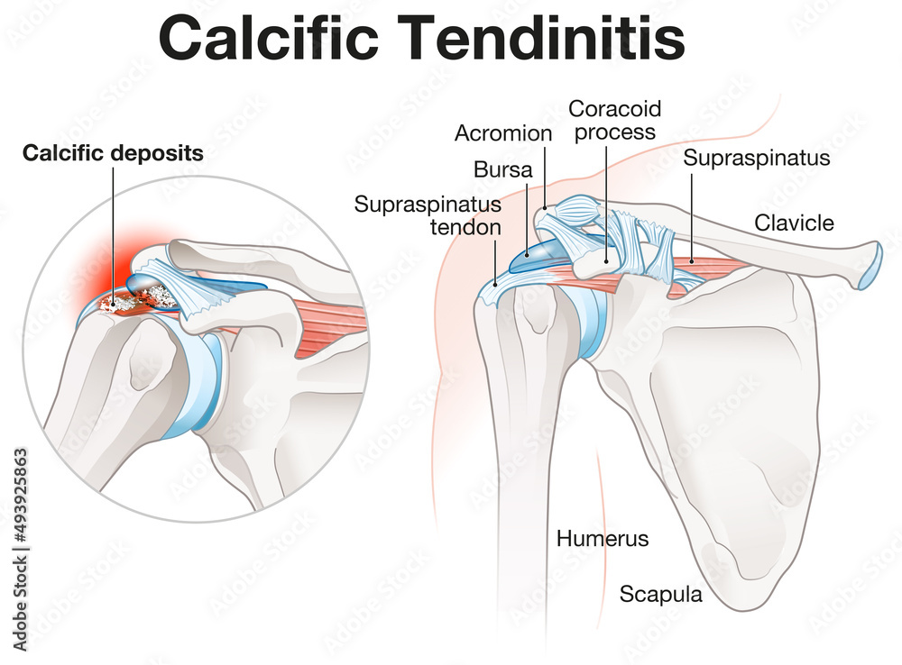 Calcific Tendinitis Shoulder Illustration. Labeled Stock Illustration ...