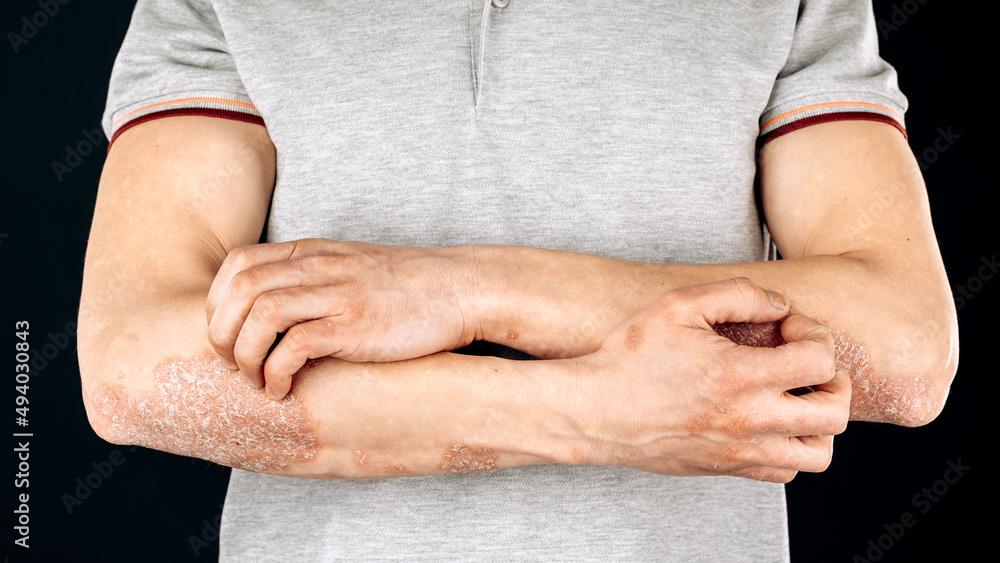 Acute psoriasis on the elbows is an autoimmune incurable dermatological ...