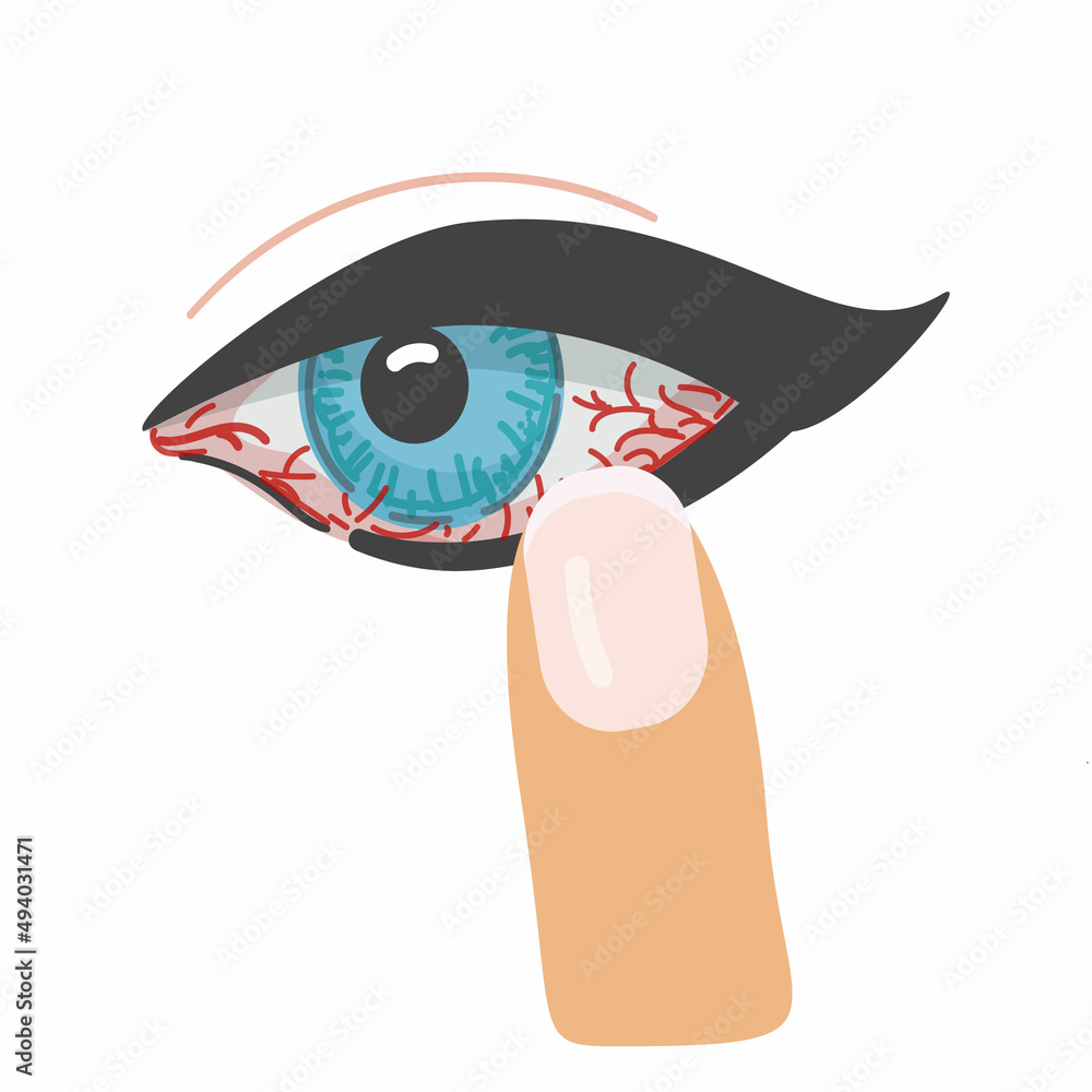 Redness of the eye. Eyeball disease. Vector illustration. Isolated icon ...