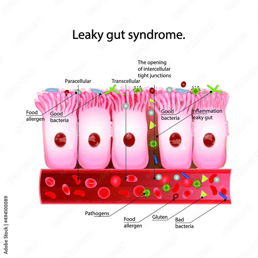 Leaky gut syndrome. Healthy cells and inflamed intestinal cells ...