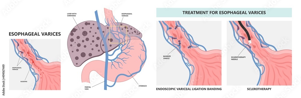 Weiss tear upper gastric ulcer portal liver veins clot blood stools ...