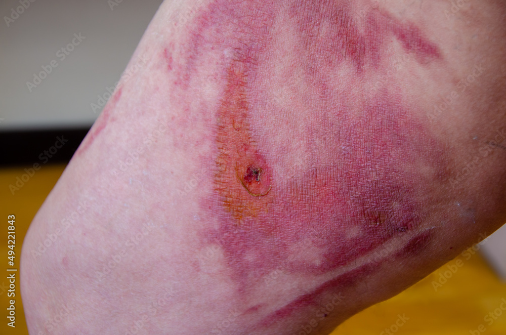 Thermal burn of skin in healing stage. Burnt skin on thigh, domestic ...