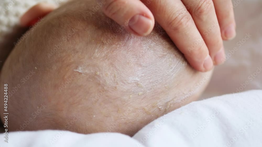 applying cream moisturizer on seborrheic dermatitis newborn baby's head ...