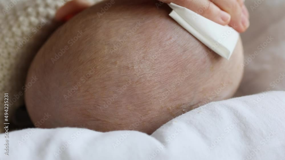 seborrheic dermatitis treatment: removing dandruff flakes off infant ...