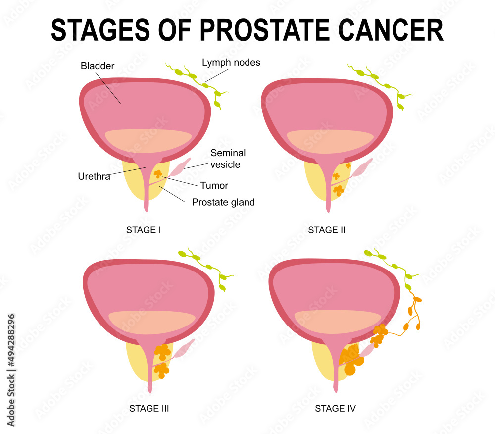 Vecteur Stock Stages of prostate cancer.Destruction of the male gland ...