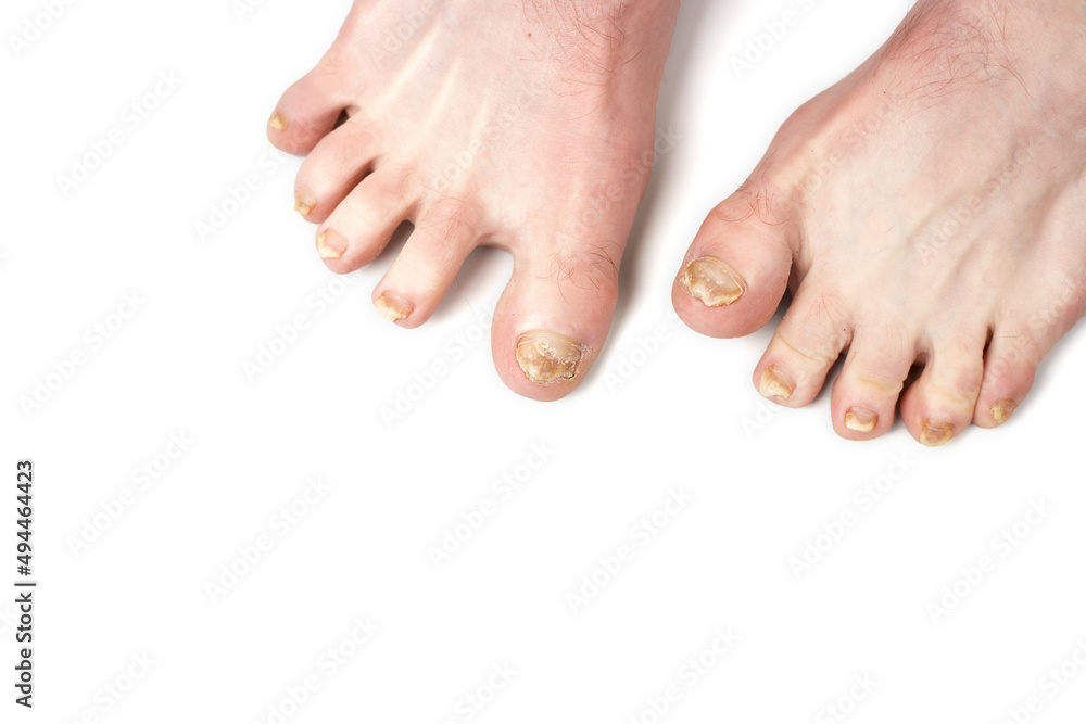 Nail fungus on legs disease. Fungal infection on nails legs, finger ...