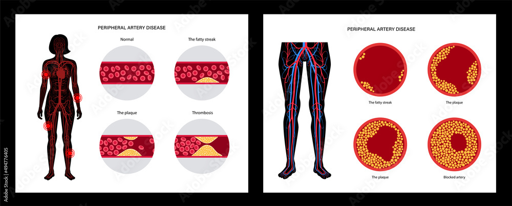 Peripheral artery disease Stock Vector | Adobe Stock