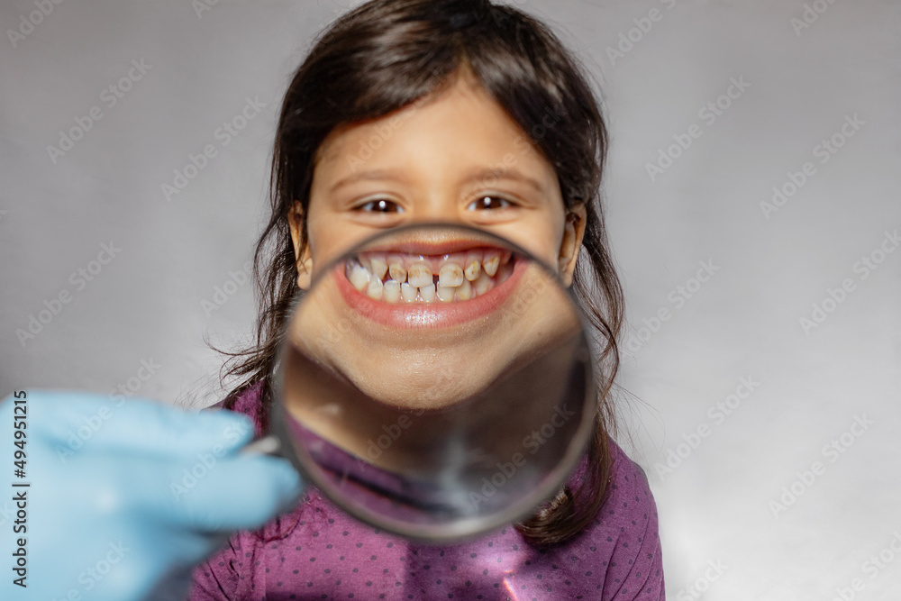 A little girl shows milk teeth with plaque and yellow spots. Children's ...