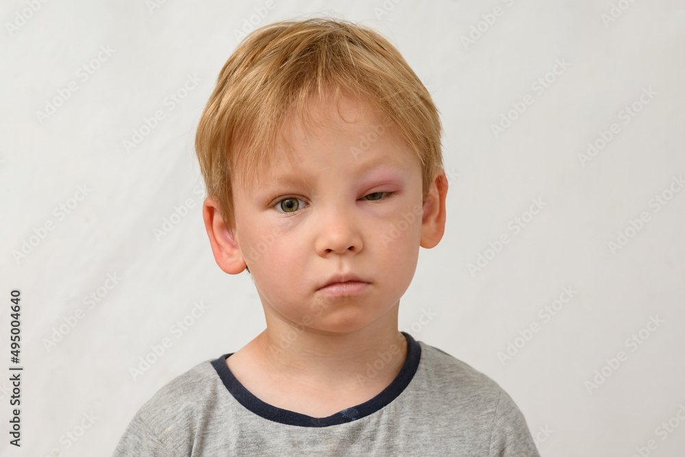 Portrait of a boy with a swollen eye from an insect bite. Allergic ...