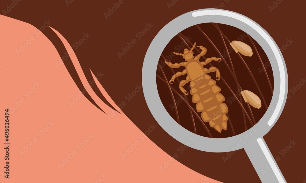 Lice Clipart 80+ Head Lice Stock Illustrations, Royalty Free Vector
