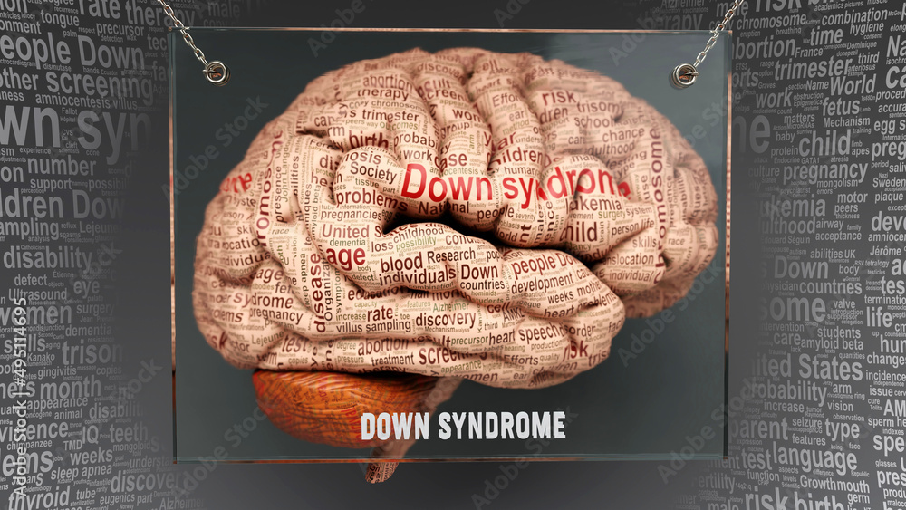 Down syndrome anatomy - its causes and effects projected on a human ...