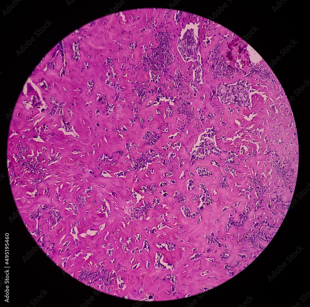 Finger (biopsy): Giant cells tumor, Microscopic view a neoplasm of ...