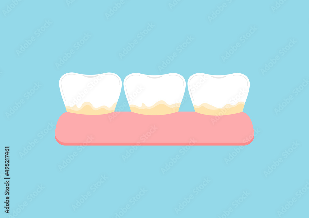Tooth with yellow tartar plaque icon. Teeth stain treatment, cleaning ...