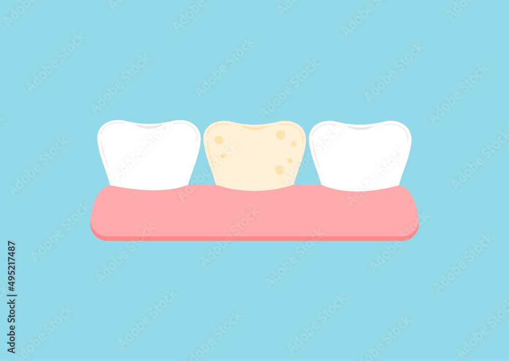 White tooth and one tooth with yellow color plaque icon. Teeth stain ...
