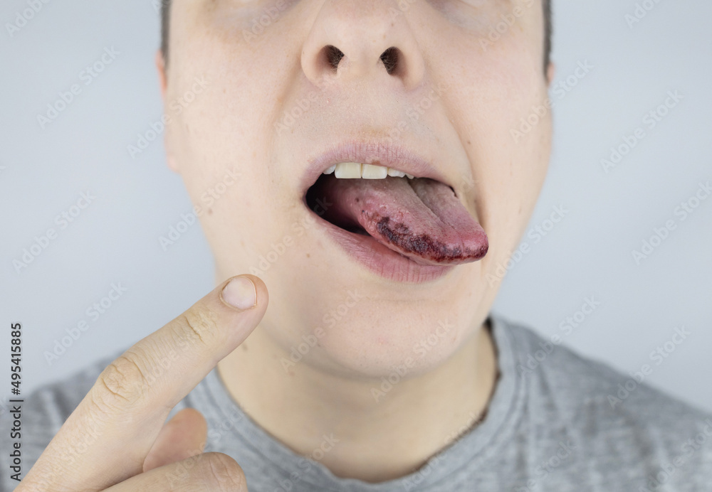 Black tongue. A man shows the consequences of an injury, bite or burn ...