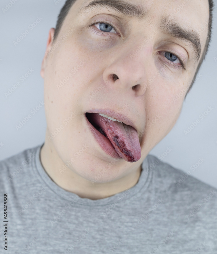 Black tongue. A man shows the consequences of an injury, bite or burn ...