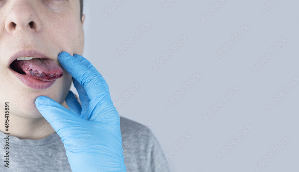 Black tongue. A man shows the consequences of an injury, bite or burn ...