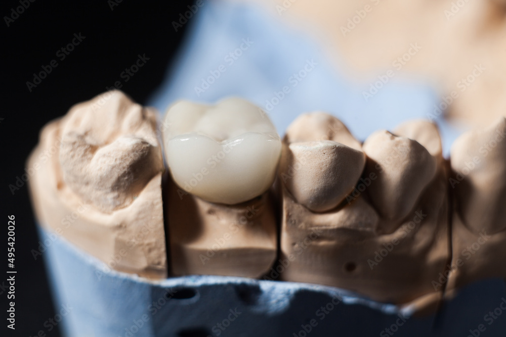 Mold of teeth. Gypsum model plaster of teeth. Stomatologic plaster cast ...