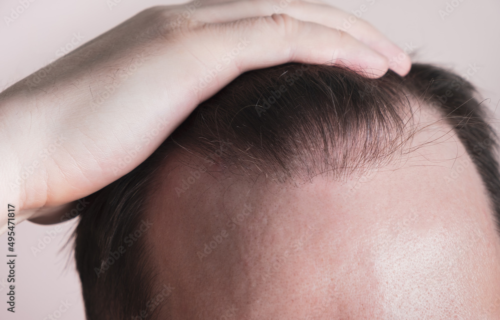 Hair loss problem. Man shows hairline on the head. Baldness treatment ...