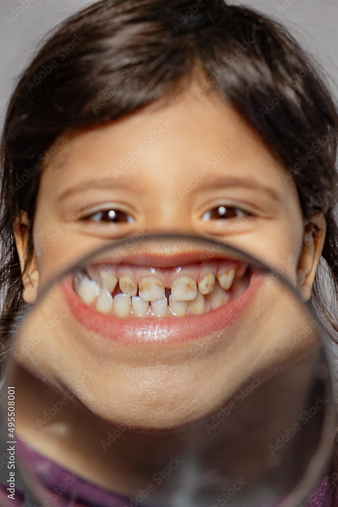 A little girl shows milk teeth with plaque and yellow spots. Children's ...