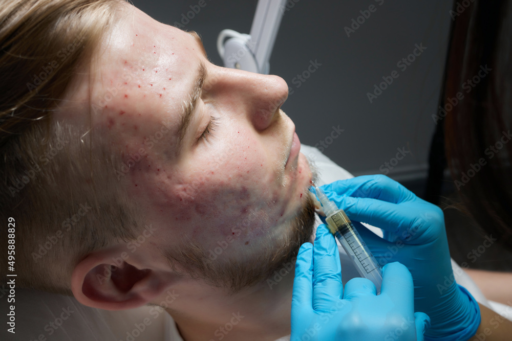 Injection at spa salon. Doctor hands in gloves. Closeup. Pretty male ...