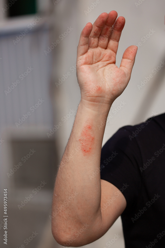 Spots, sores on human skin. Infection rash, psoriasis, eczema, lichen ...