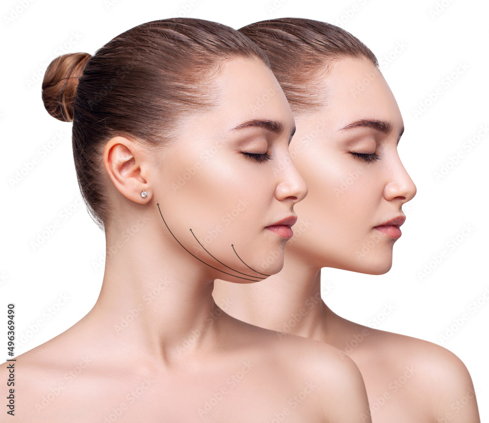 Beautiful woman before and after fat chin correction. Stock Photo ...