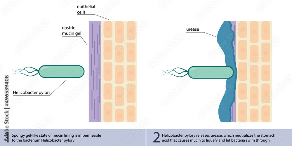 Invasion of Helicobacter pylori into the tissues of the stomach, by ...