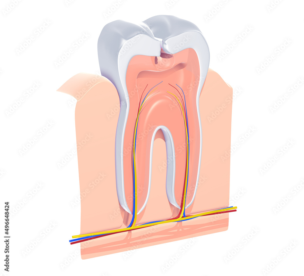 3d illustration of the anatomical view of a tooth damaged by caries ...