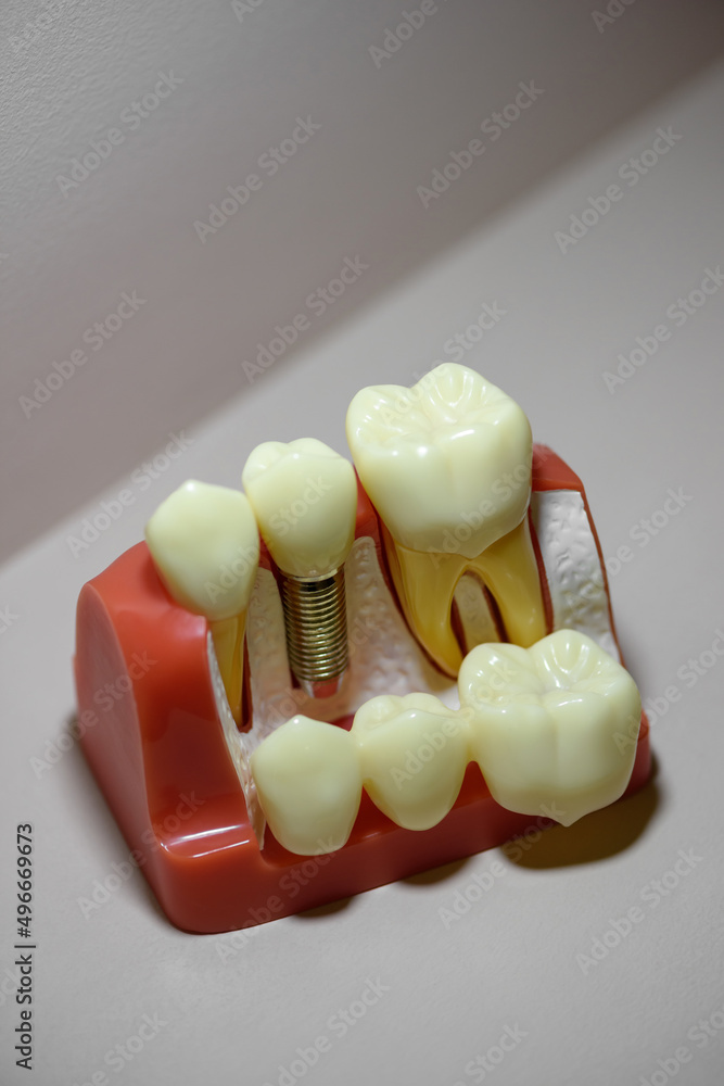 Model of teeth with a dental implant. Cross-sectional mock-up of a ...